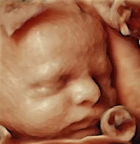 Nuchal Translucency Scan Sydney 12 14 Weeks Cfwu