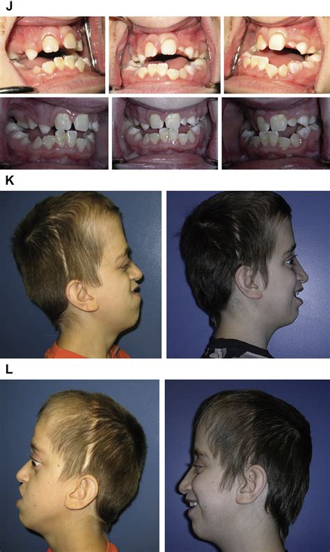 Le Fort Iii And Le Fort Ii Osteotomies Atlas Of The Oral And