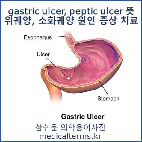 의학용어 Gastric Ulcer Peptic Ulcer 뜻 위궤양 소화성궤양 원인 증상 치료 참쉬운 의학용어사전