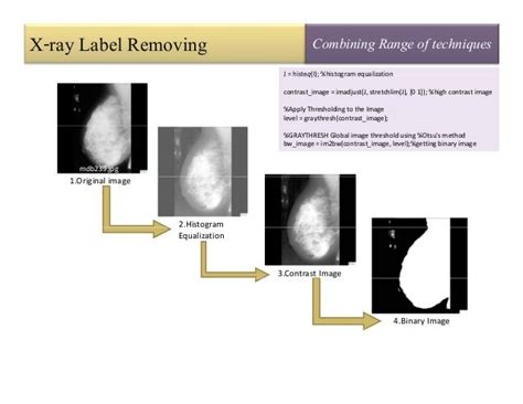 Microcalcification Identification In Digital Mammogram For Early Dete…
