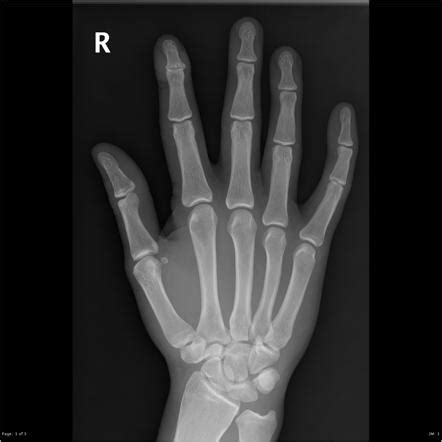 Mallet Finger Radiology Case Radiopaedia Org