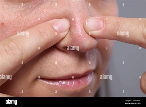 Woman Popping Pimple On Her Nose Against Grey Background Closeup Stock Photo Alamy