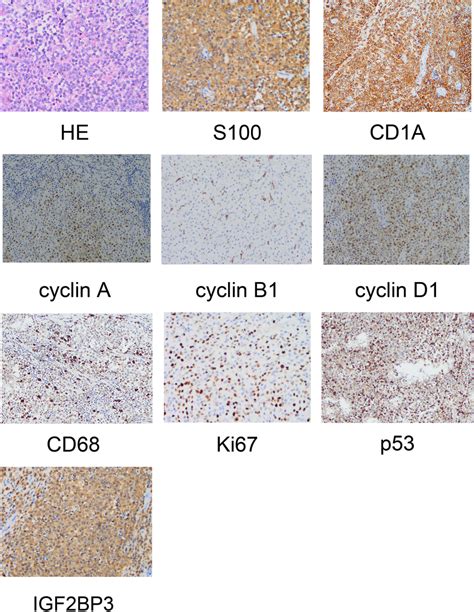 Pathological Examination Revealing The Morphology Of Langerhans Cell