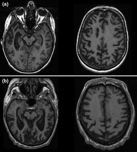 Contrasting Atrophy Patterns For Behavioral Variant Frontotemporal