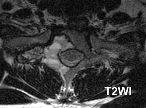 Classic Case American Journal Of Neuroradiology