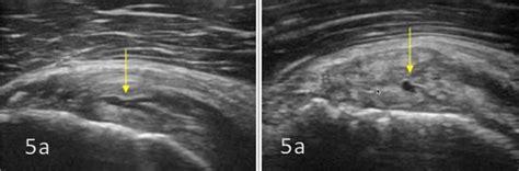 Using Msk Ultrasound In The Evaluation Of Subscapularis Injuries Published In International