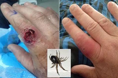 False Widow Spiders Latest News Updates Pictures Video Reaction