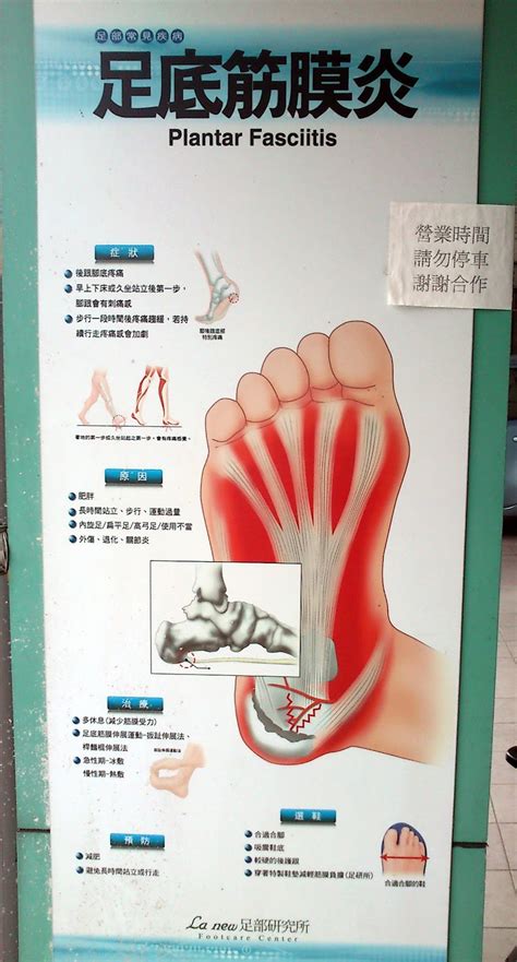 Plantar Fasciitis