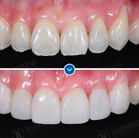 라미네이트 강남레옹치과