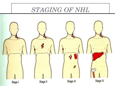 Non Hodgkins Lymphoma