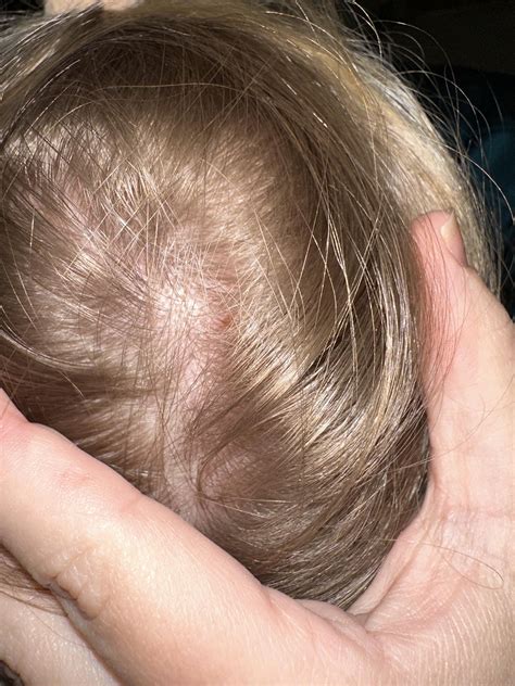 Scabs On Scalp Rdermatologyquestions