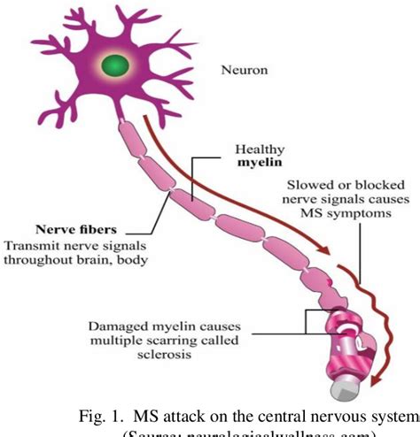 figure 1 from severity classification of multiple sclerosis disease a