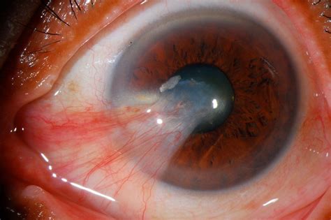 Pterygium Conjunctivae Wikipedia