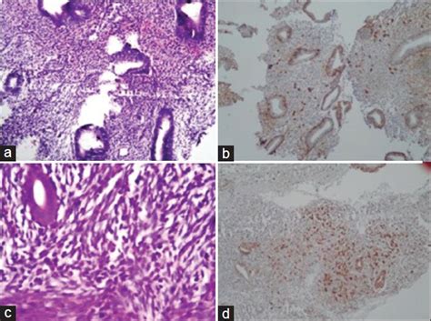 Evaluation Of Endometrium For Chronic Endometritis By Using Syndecan 1