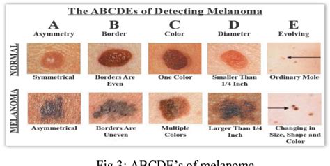 Table 1 From Identification Of Melanoma In Dermoscopy Images Using Image Processing Algorithms