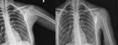 X Ray View Of Left Shoulder Showed Lytic And Expansile Lesion Of The