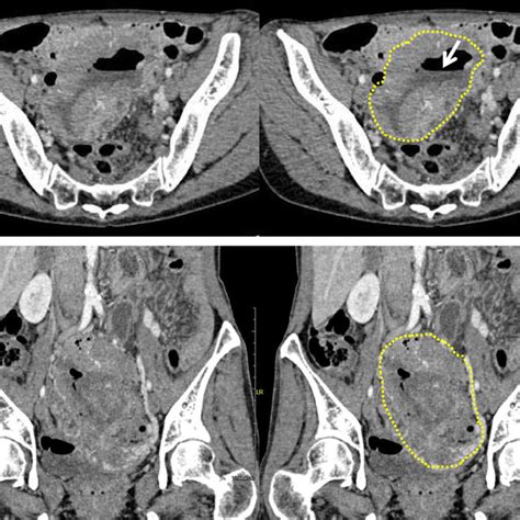 A B Contrast Enhanced Computed Tomography Scan Of The Lower Abdomen