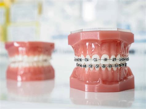 Orthodontic Myths Debunked Common Misconceptions About Braces Treatment