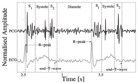 Phonocardiogram Signal Download Scientific Diagram