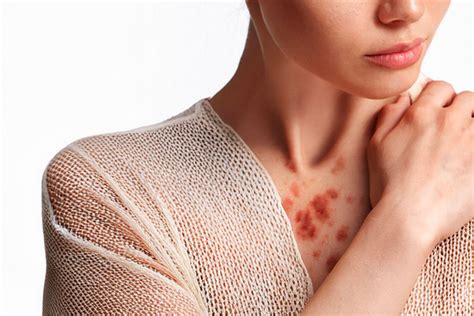 Dermatiti Tipologie Sintomi E Cause Dottssa Sonia Musumeci