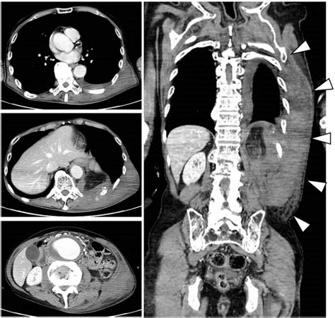 Imaging With Ct Angiography Cta From The Chest To The Pelvis Download Scientific Diagram