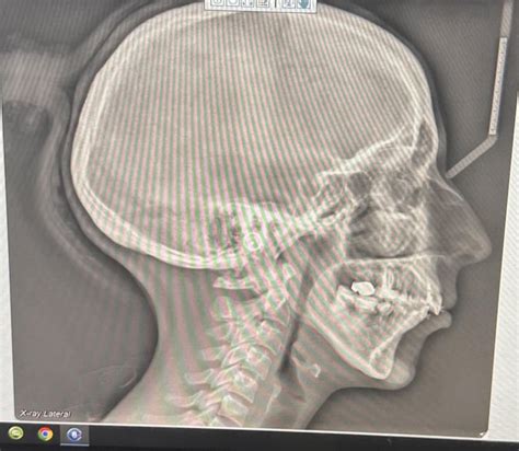 Do You Think My Class 2 Is Only Fixable With Double Jaw Surgery And