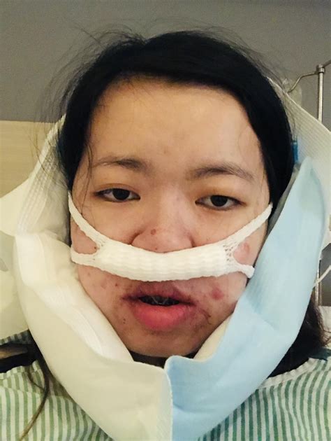 Survived The First Day R Jawsurgery