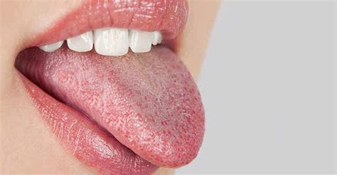 5 Remedios Caseros Para Aliviar La Boca Seca Mejor Con Salud