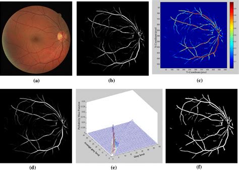 Steps In The Proposed Vessel Segmentation Procedure A A Sample Fundus Download Scientific