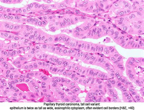 Pathology Outlines Papillary Carcinoma Tall Cell Variant