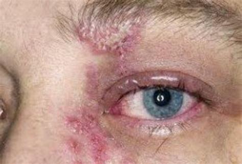 What Is Shingles Causes Symptoms And Treatment Hubpages