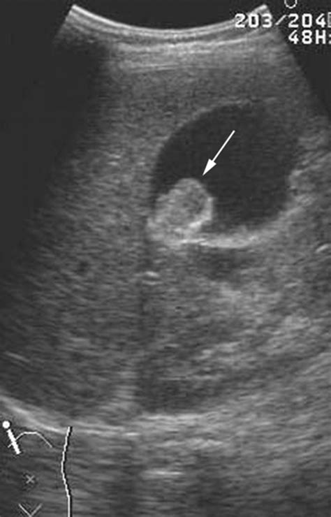 Gallbladder Polyps Ultrasound