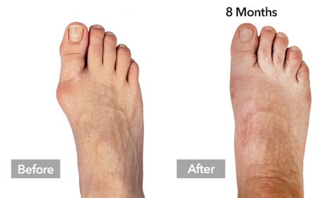 Lapiplasty New England Podiatry