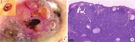Basal Cell Carcinoma Vs Squamous Cell Carcinoma Histology
