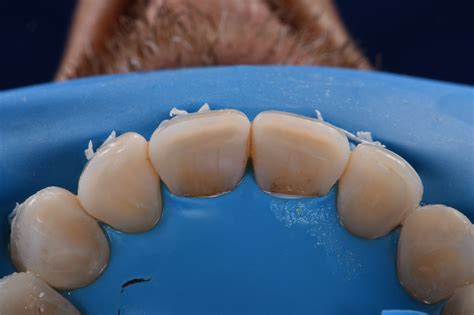 Dental Erosion Restorations Dental Erosion Restorations