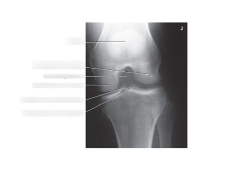 Pa Axial Intercondylar Fossa Diagram Quizlet