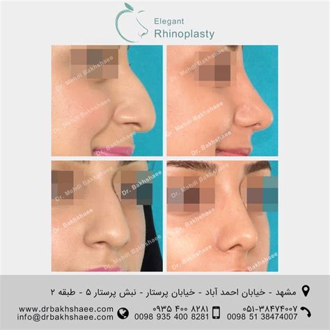 دکتر مهدی بخشایی فلوشیپ فوق تخصصی اندوسکپی سینوس و زیبایی بینی جراحی زیبایی جراحی بینی دکتر