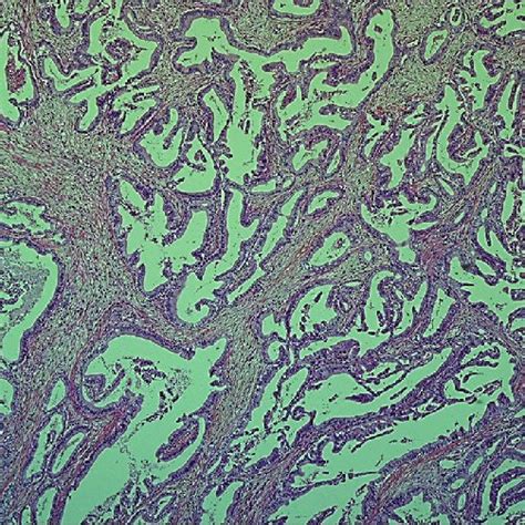 Histological Findings Of The Resected Specimens Pancreatic Head A