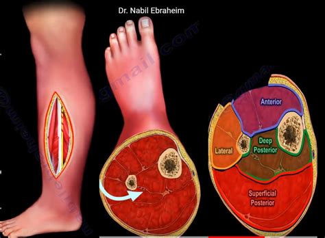 Single Incision Fasciotomy For Compartment Syndrome