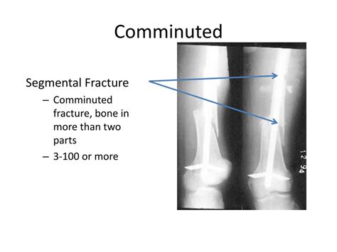 Ppt Bone Fracture Patterns Bone Healing Fracture Management