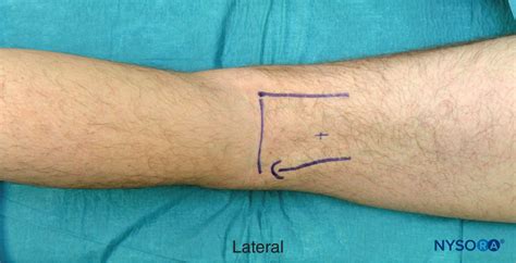 Popliteal Sciatic Nerve Block Landmarks And Nerve Stimulator
