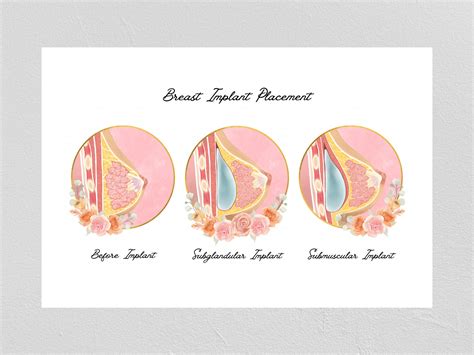 Breast Augmentation Poster Plastic Surgery Print Breast Implants
