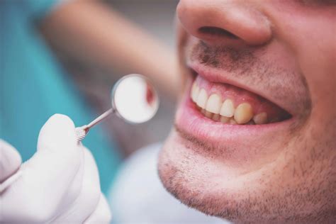 Teeth Stains Causes Types How To Remove Them