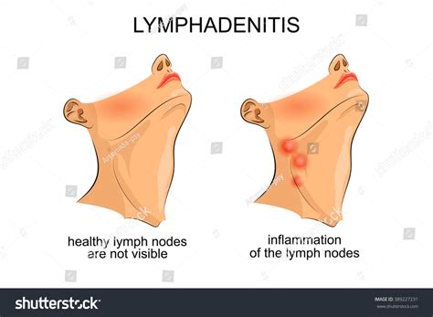 Submandibular Lymph Node Swelling