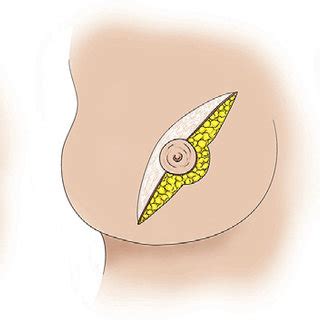 Intra Operative Detail The Edges Of The Indentation Were Incised And Download Scientific