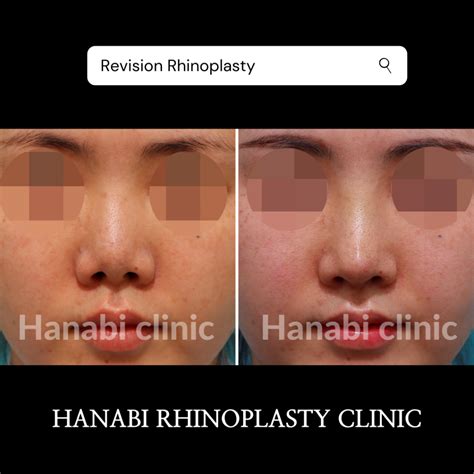 Before And After Image Of Revision Rhinoplasty For Short Nose Hanabi