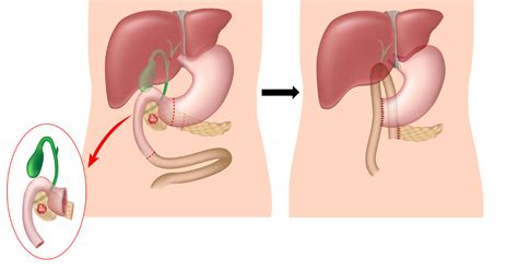 Whipple Procedure Purpose Preparation Procedure Risks