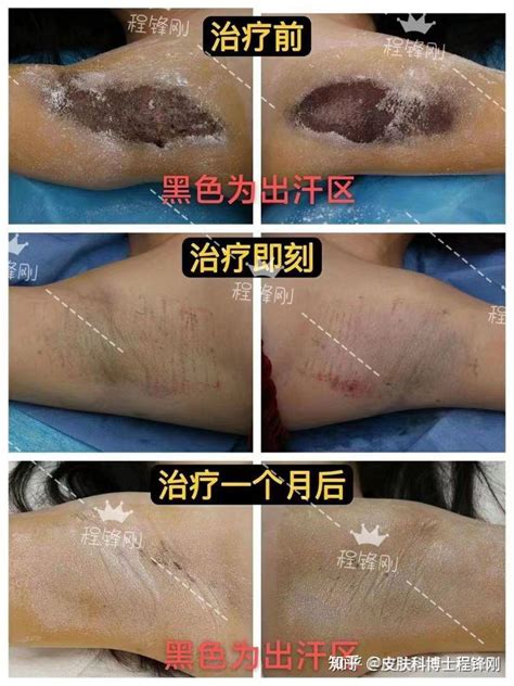 腋下出汗严重该怎么解决？ 知乎