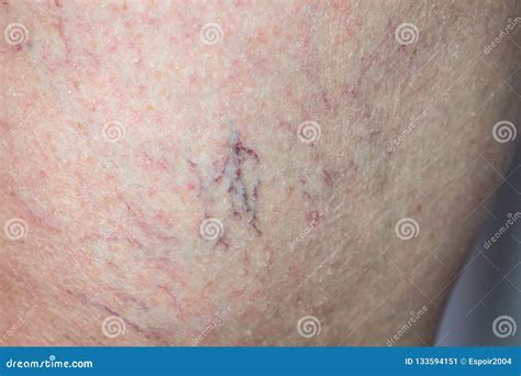 Footprint On The Skin From Vascular Dilatation Of Veins Stock Image