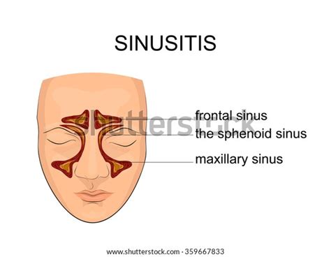 Nasal Sinus Inflammation Stock Vector Royalty Free 359667833